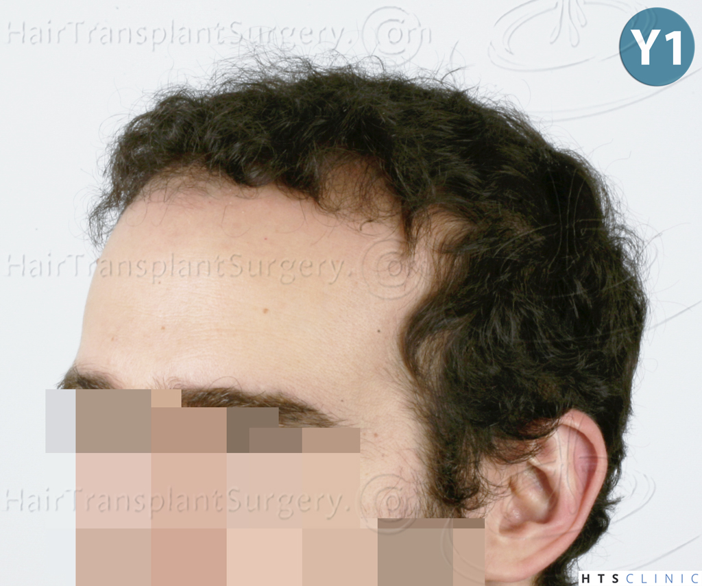 Dr Jean Devroye Hts Clinic 3920 Fut Frontal Area And Midscalp